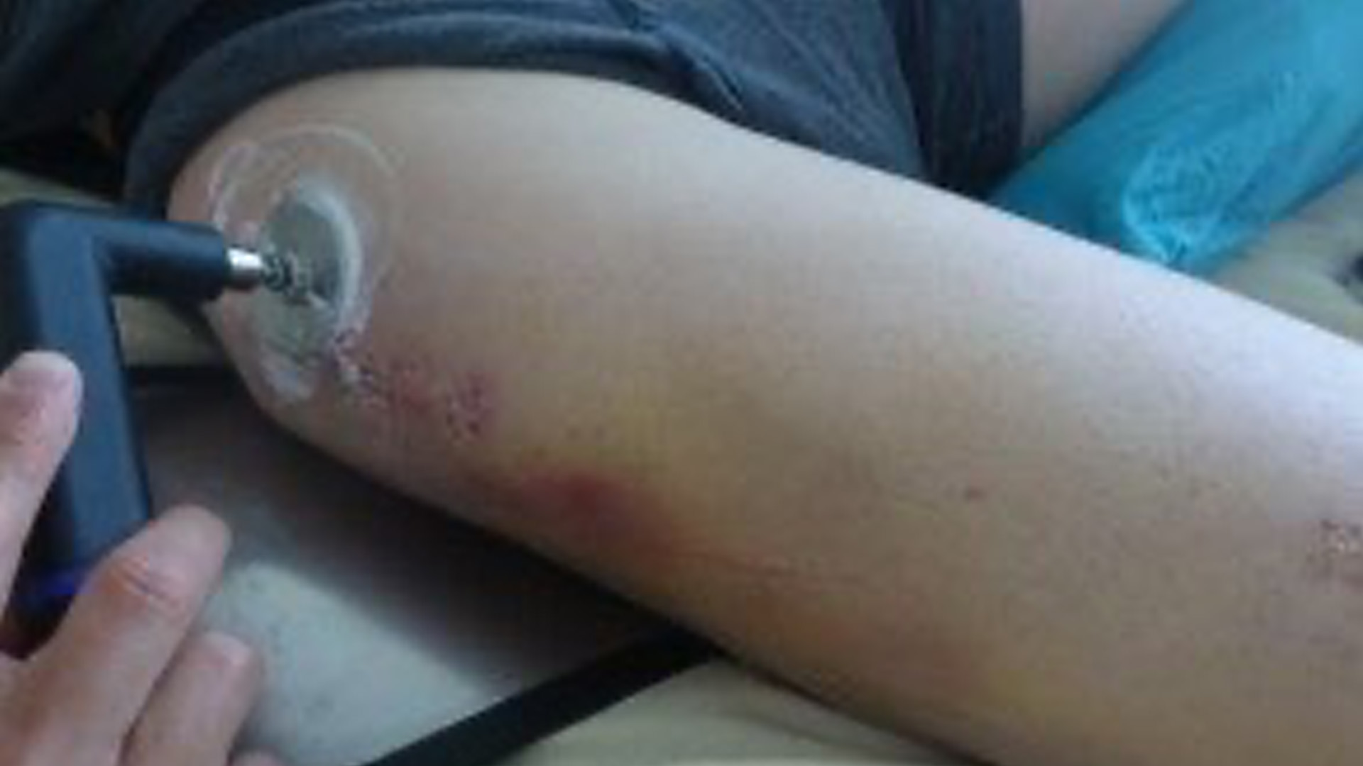 The Therapeutic Effects of INDIBA Radiofrequency Therapy in Sports ...